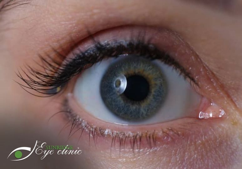 Eye Exams Calgary, Calgary Optometrists - Sunridge Eye Clinic