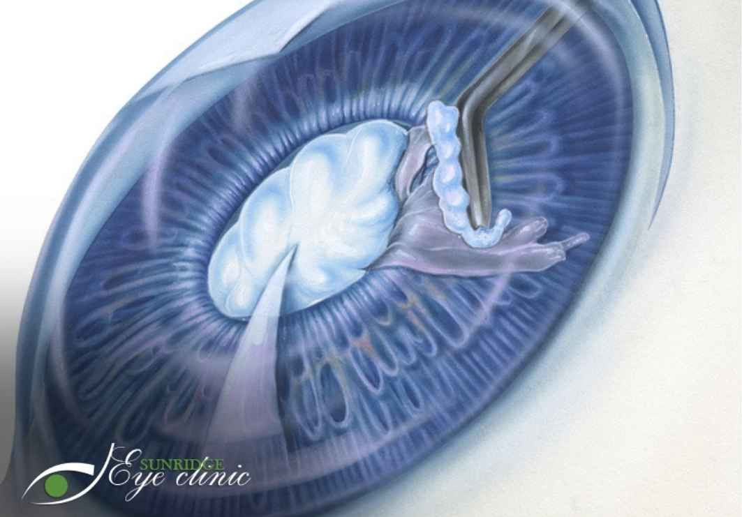 Eye Exams Calgary, Calgary Optometrists - Sunridge Eye Clinic